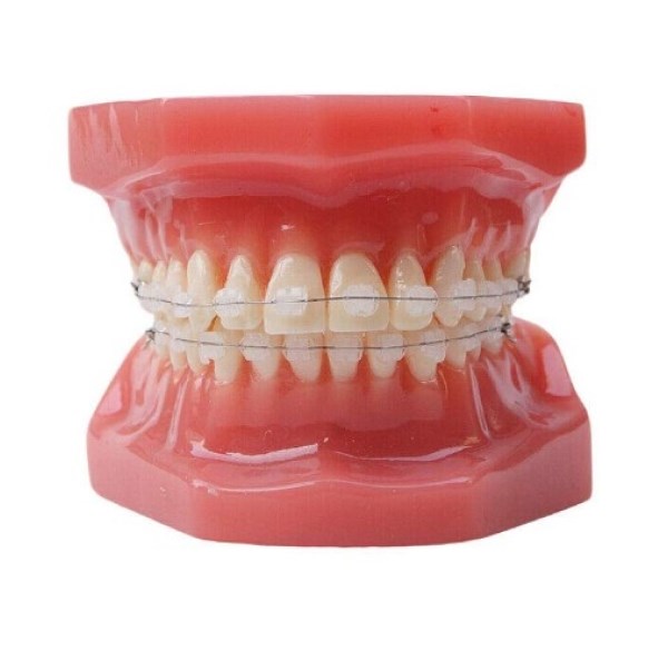 Types of Braces | Dr. Gail Schupak Orthodontics NYC