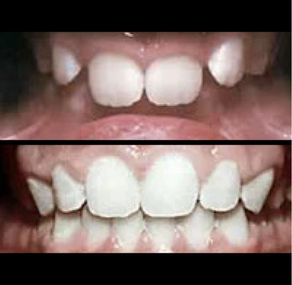Transformative Orthodontic Before and After Photos